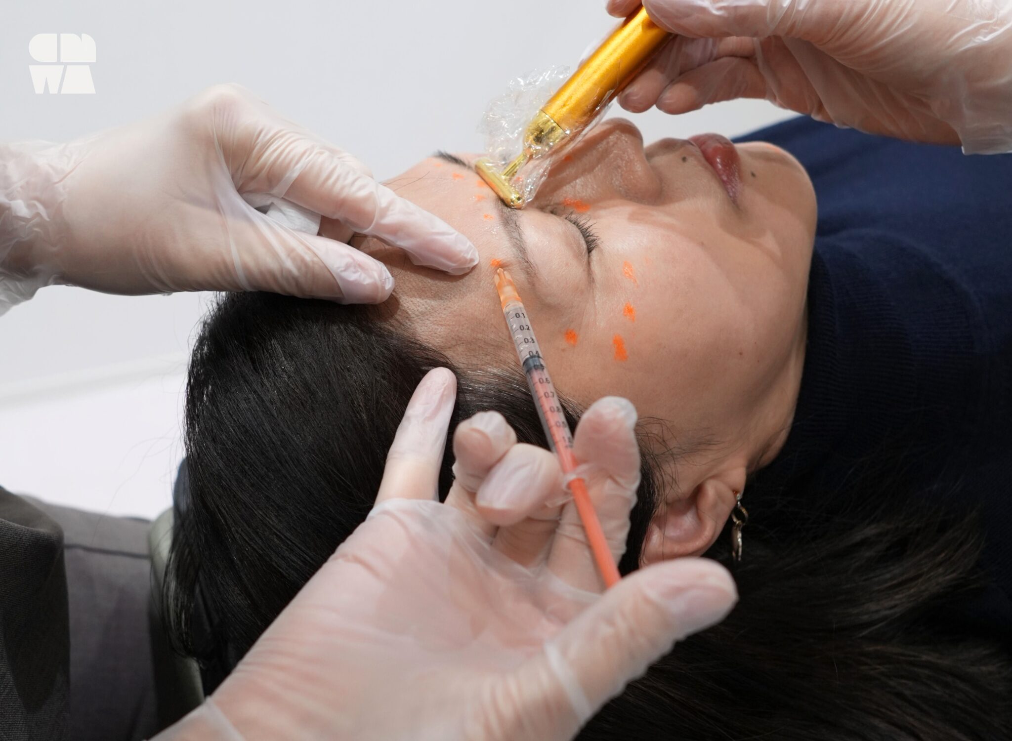 ボトックス注射（アラガン・ボツラックス） でシワ改善｜原宿・明治神宮前｜CHINOWA CLINIC